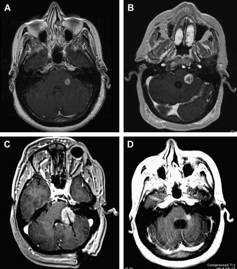 Management Of Brain Metastases Oncohema Key