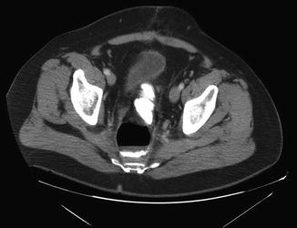 Complications After Rectal Cancer Surgery Oncohema Key